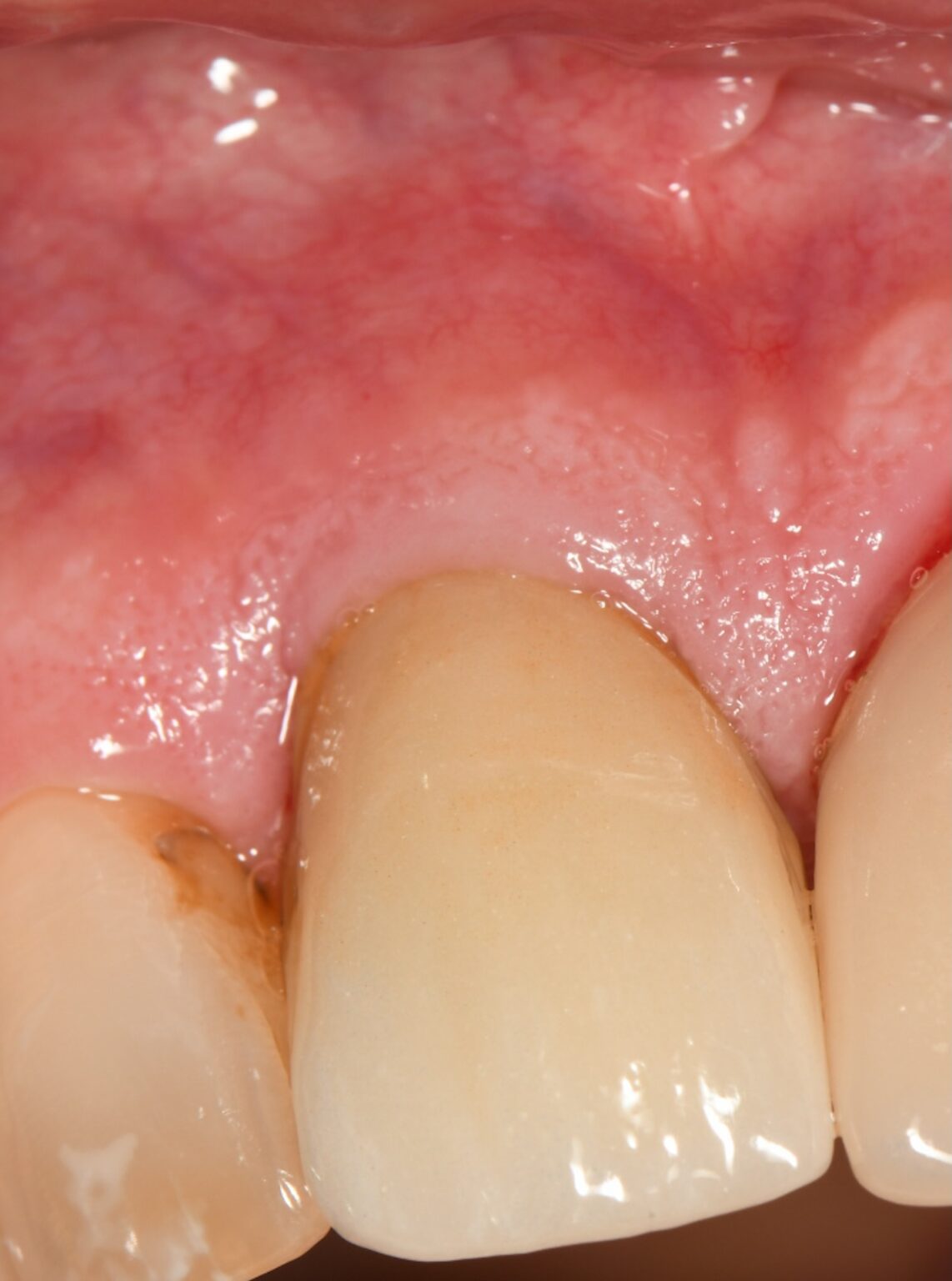Immediate or Delayed Dental Implant Placement Care